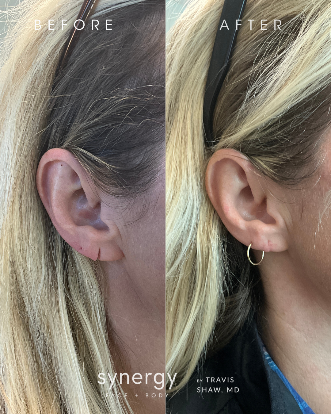 Body Piercing Repair | Richmond and Midlothian, VA | Travis Shaw, MD